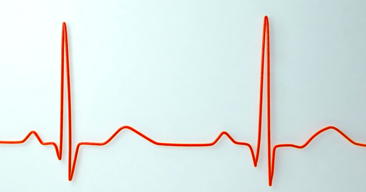 Hartpatiënten krijgen te vaak onnodig een inwendige defibrillator ...