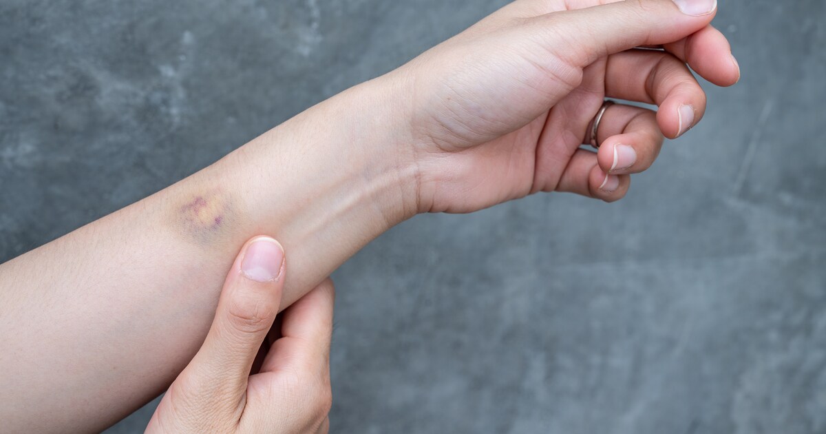 Wat is een hematoom (en wanneer is dit gevaarlijk)? | Margriet