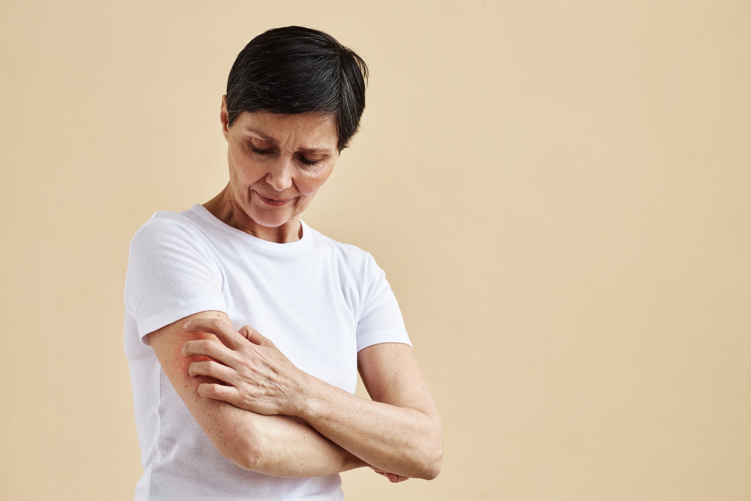 Muggenallergie? Dit wil je weten over het Skeeter-syndroom | Margriet