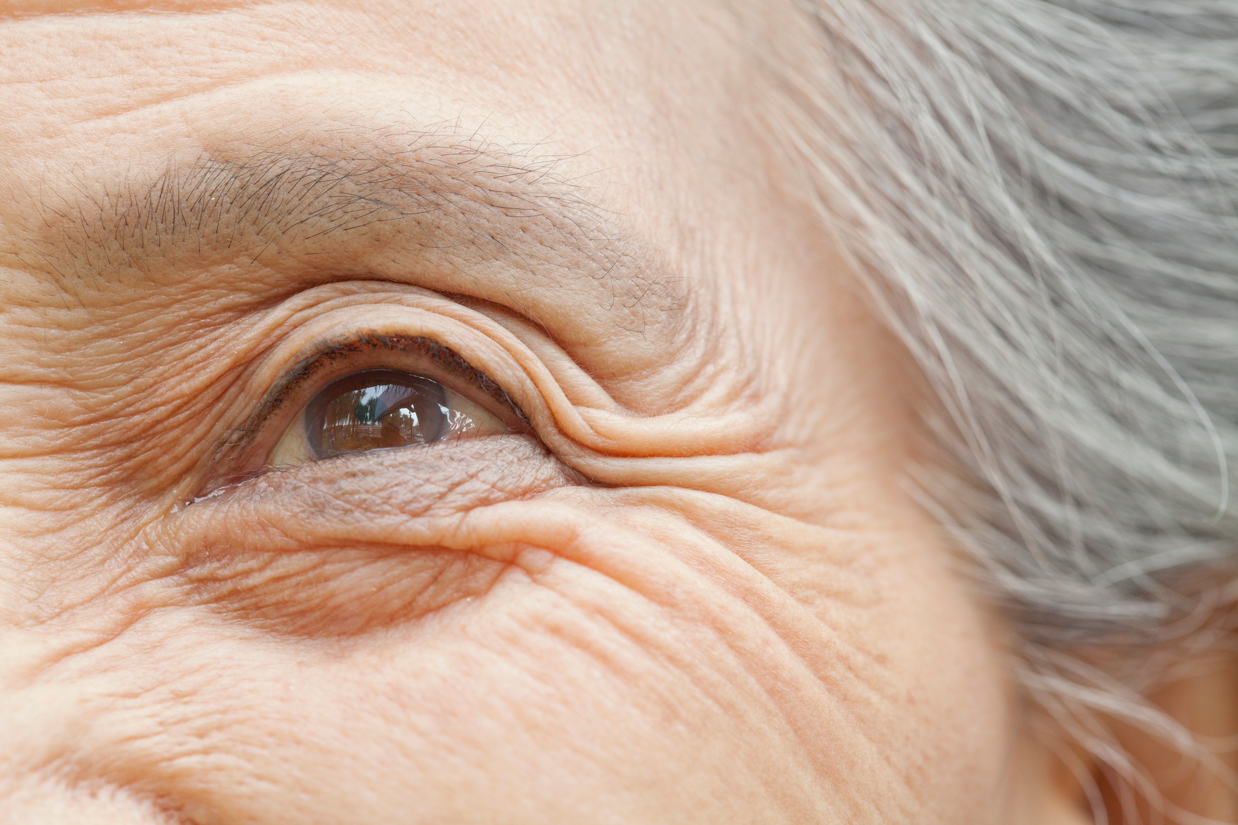 Oogtrombose: symptomen, oorzaken en behandeling van trombose in het oog ...